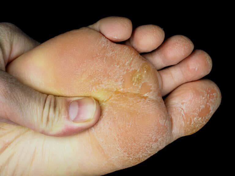 9 Proven Ways to Remove Dead Skin on Your Feet - Own Harmony